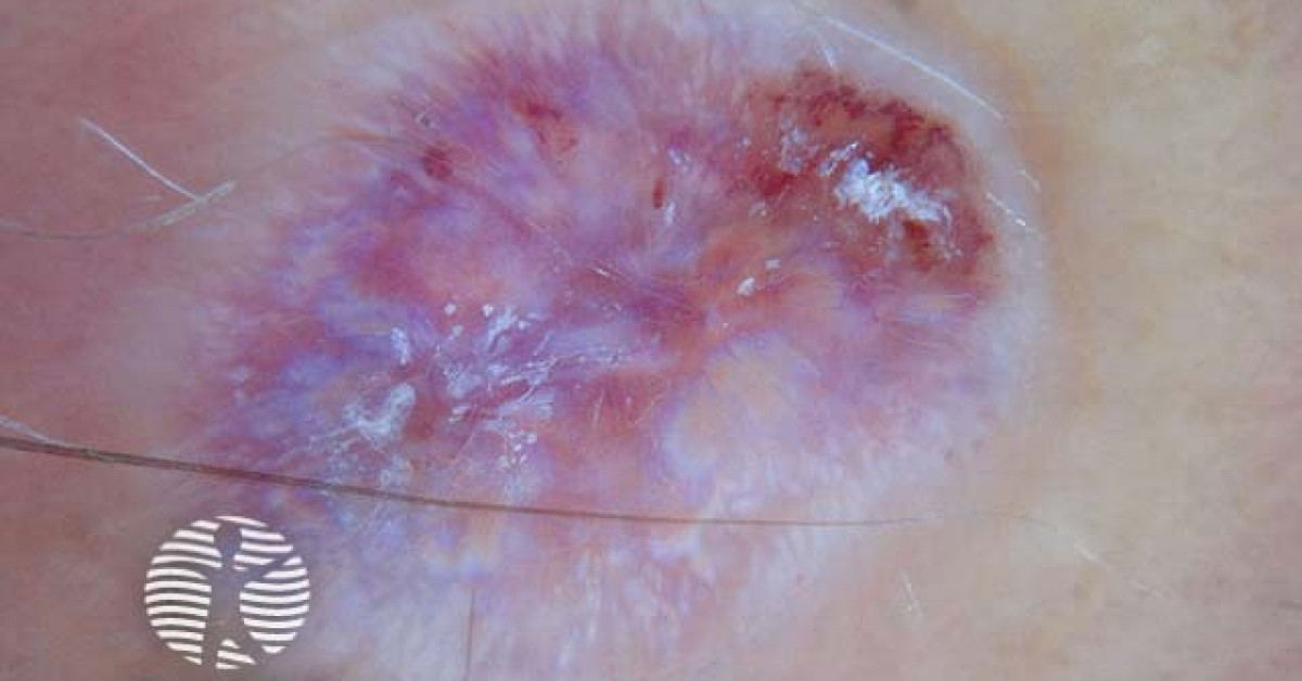 Rainbow pattern dermoscopy of dermatofibroma image