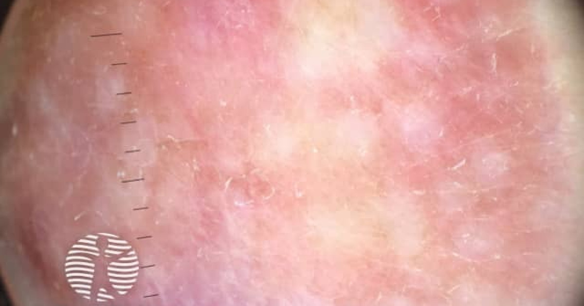 Dermoscopy of dermatofibrosarcoma protuberans image