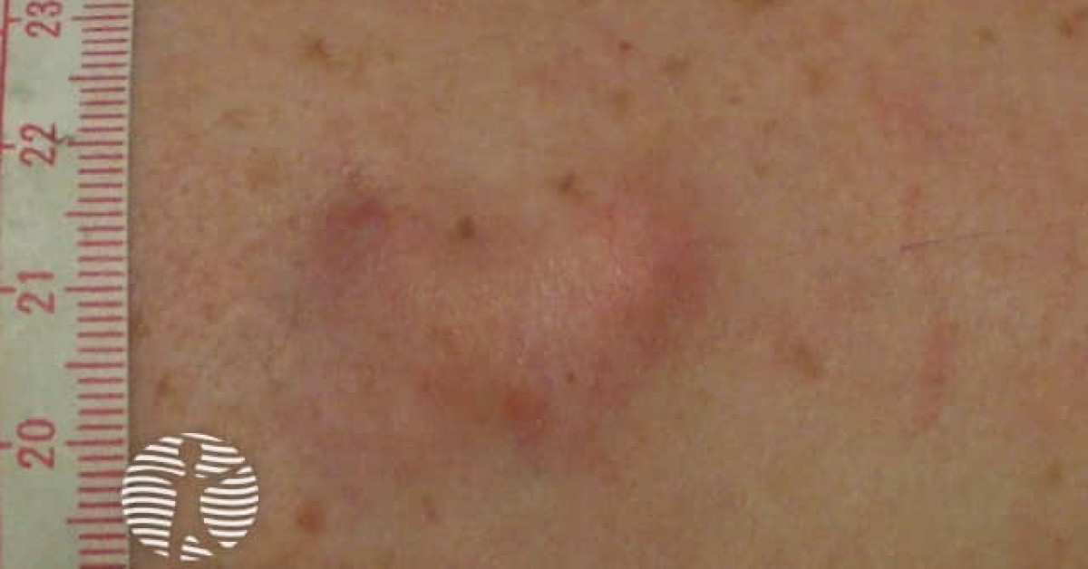Dermatofibrosarcoma protuberans image