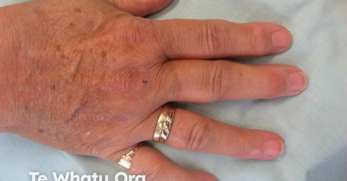 Diabetic stiff skin image