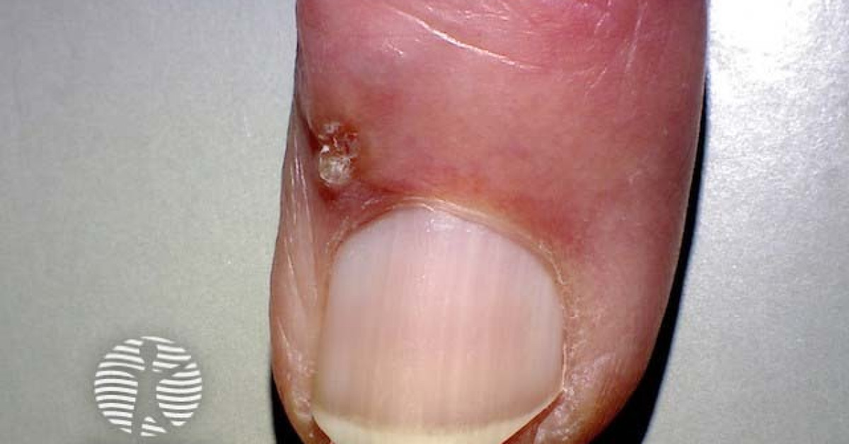 Digital Myxoid Cyst Image