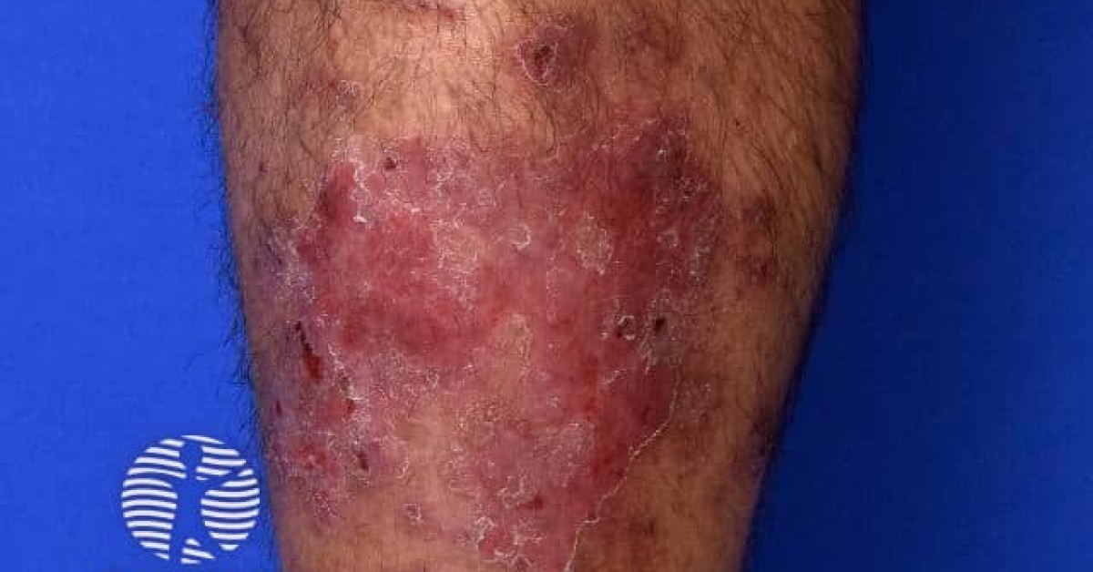 Nummular dermatitis image