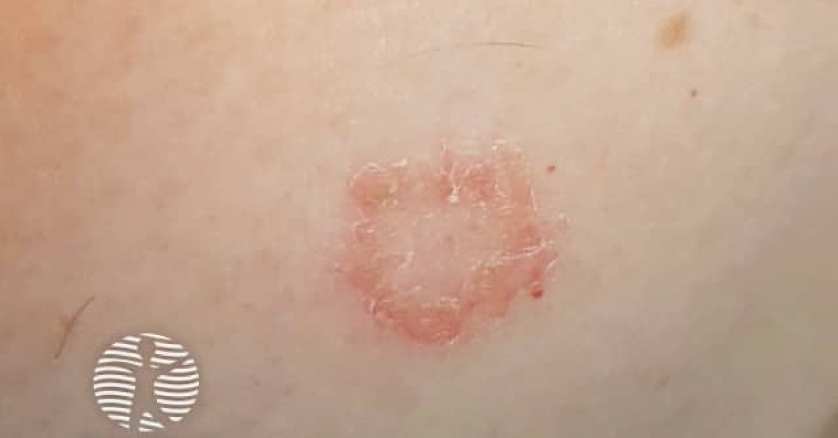 Discoid eczema day 10 image