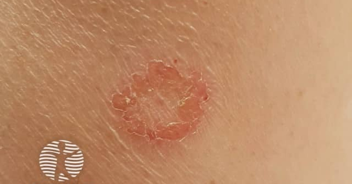 Discoid eczema day 13 image