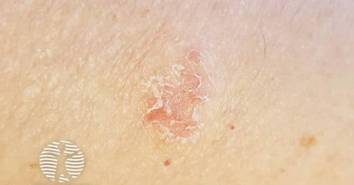 DermNet® - Discoid eczema day 2 image
