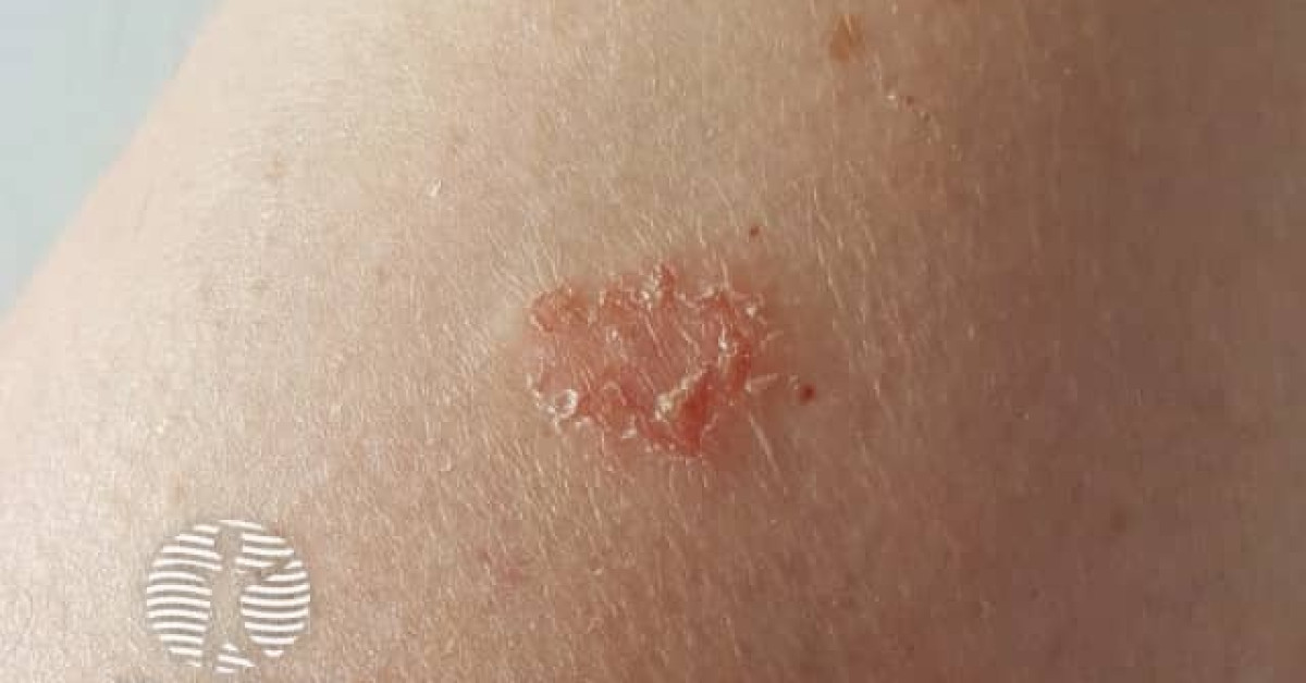 Discoid eczema day 6 image