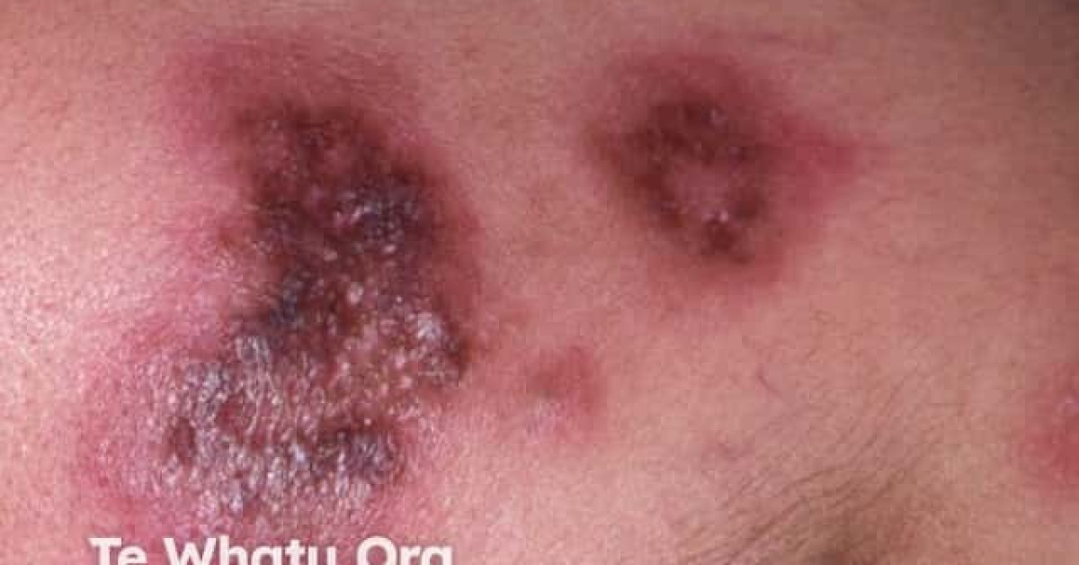 Discoid lupus erythematosus image