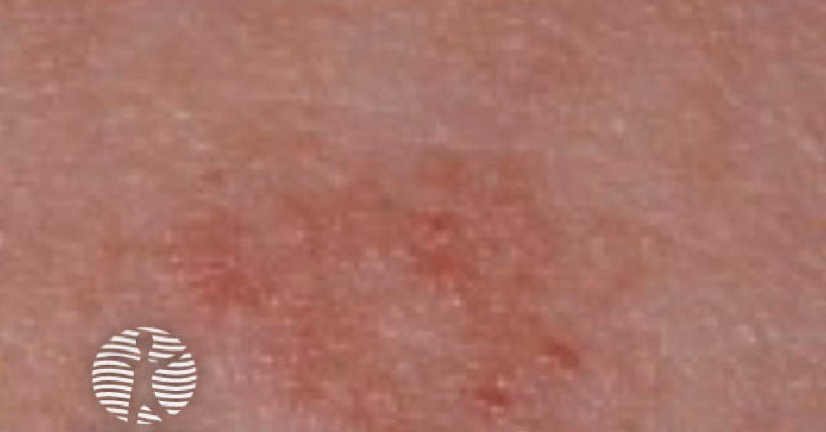 disperse blue patch sm image