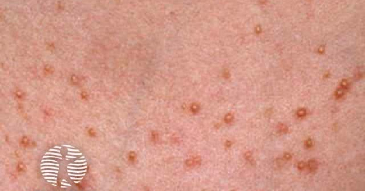 Pityrosporum folliculitis image