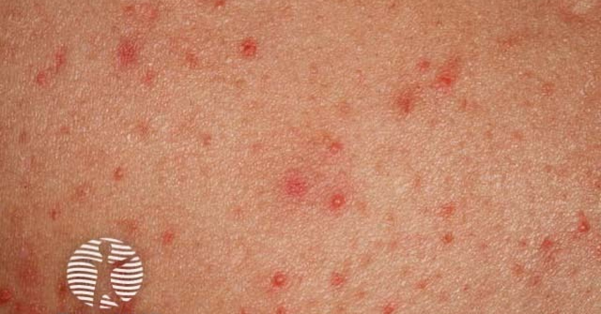 DermNet® - Pityrosporum folliculitis image
