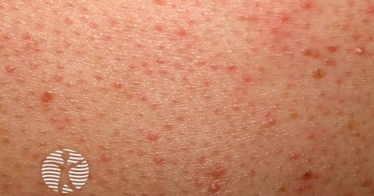 Pityrosporum folliculitis image