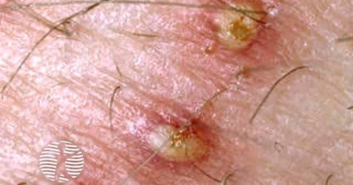 Folliculitis Patient Education | Inspirational Education