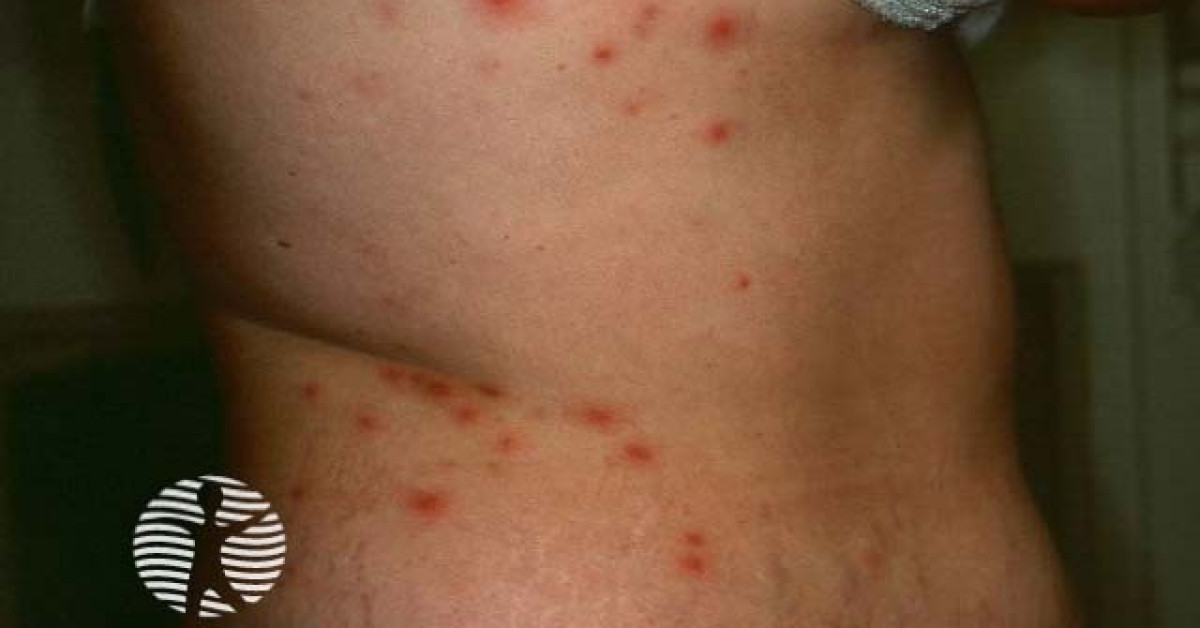 Pseudomonas folliculitis image
