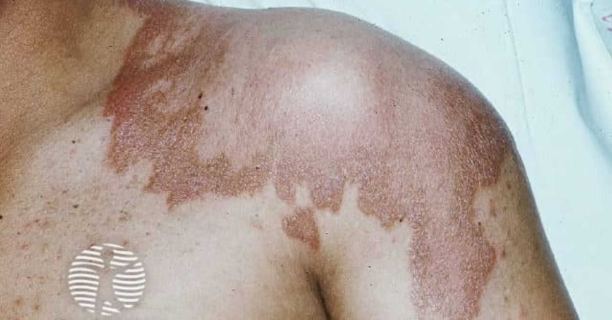 DermNet® - leprosy image