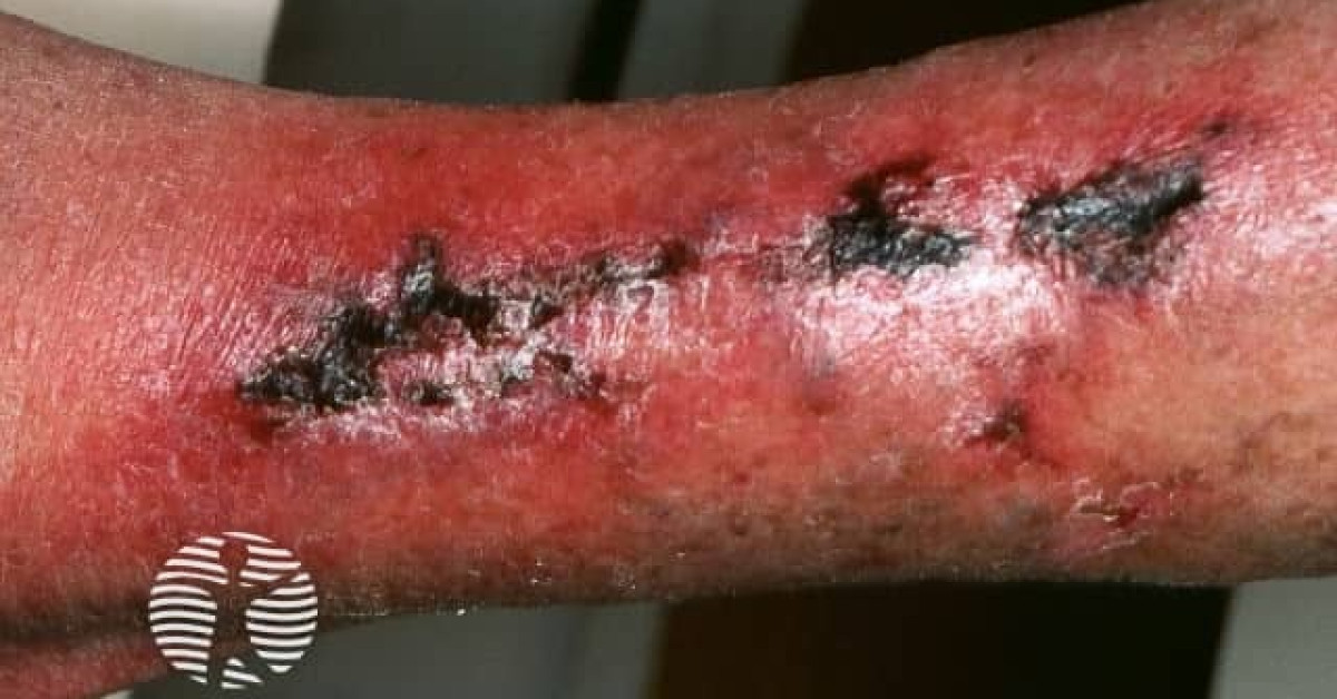Necrotising fasciitis image