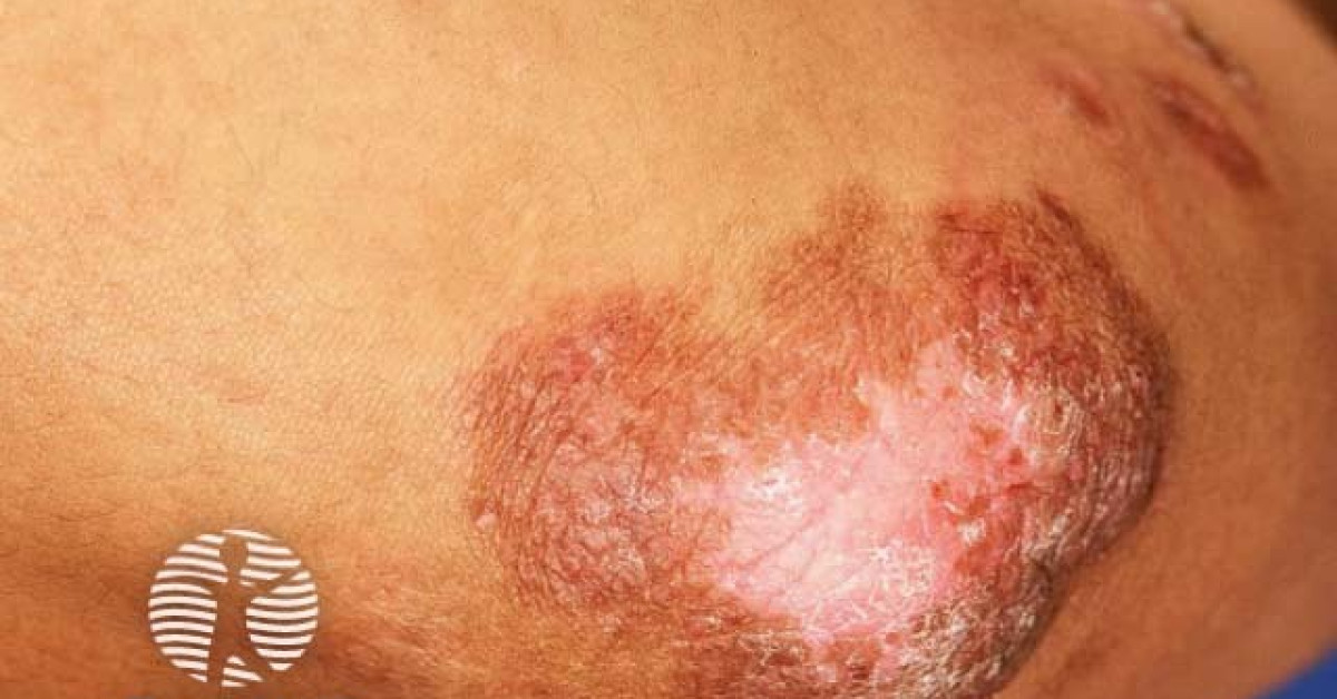 Cutaneous TB image