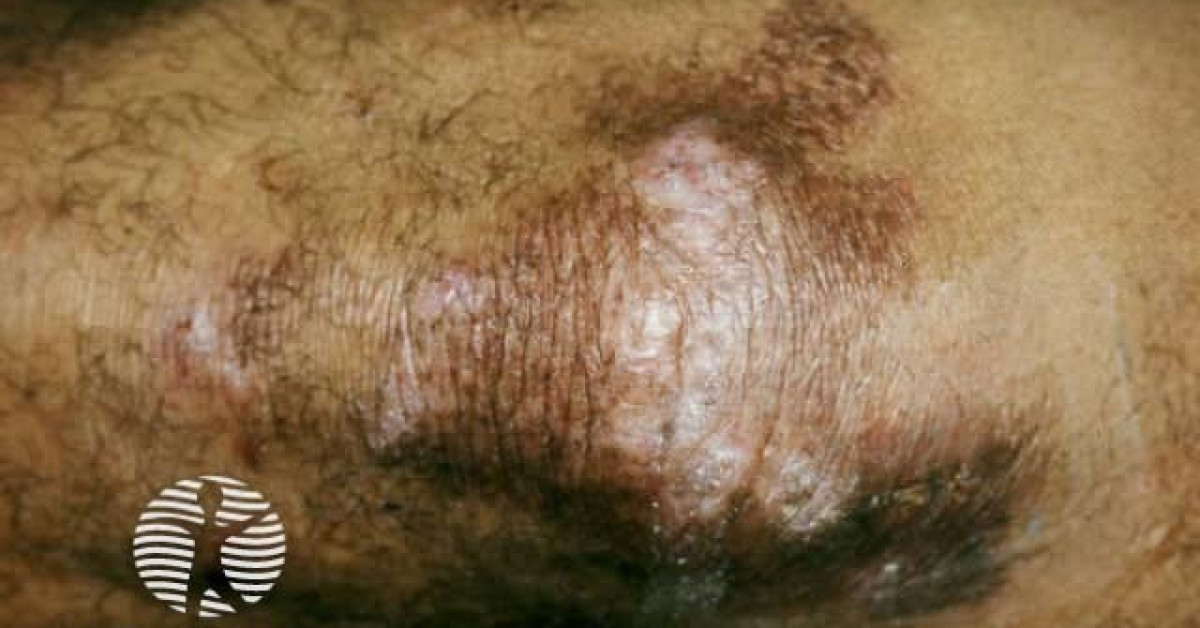 Cutaneous TB image