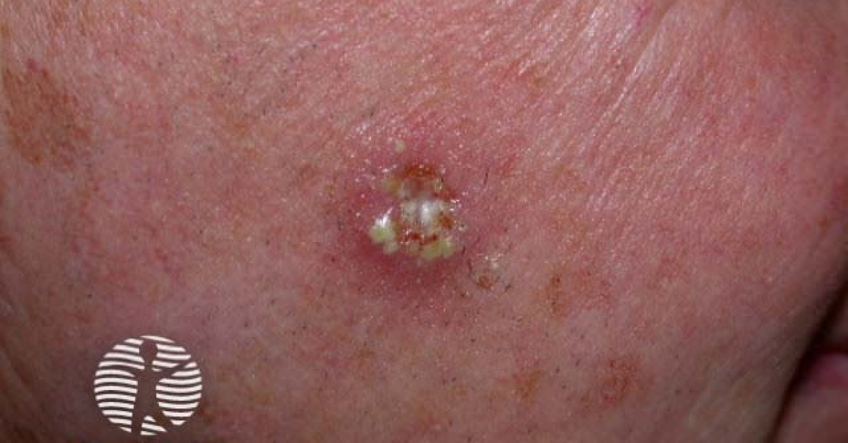 Wound infection image
