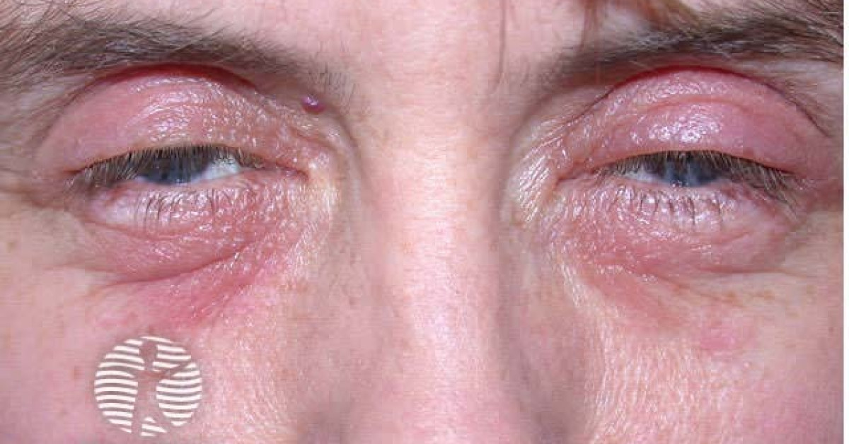 Acute dermatitis image