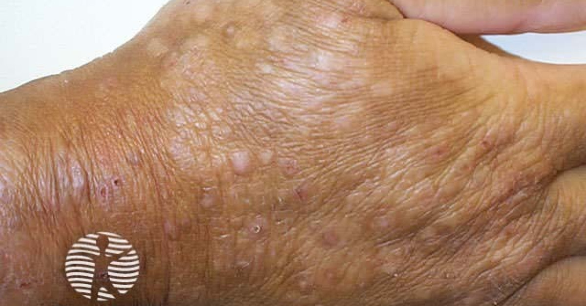 Chronic dermatitis image