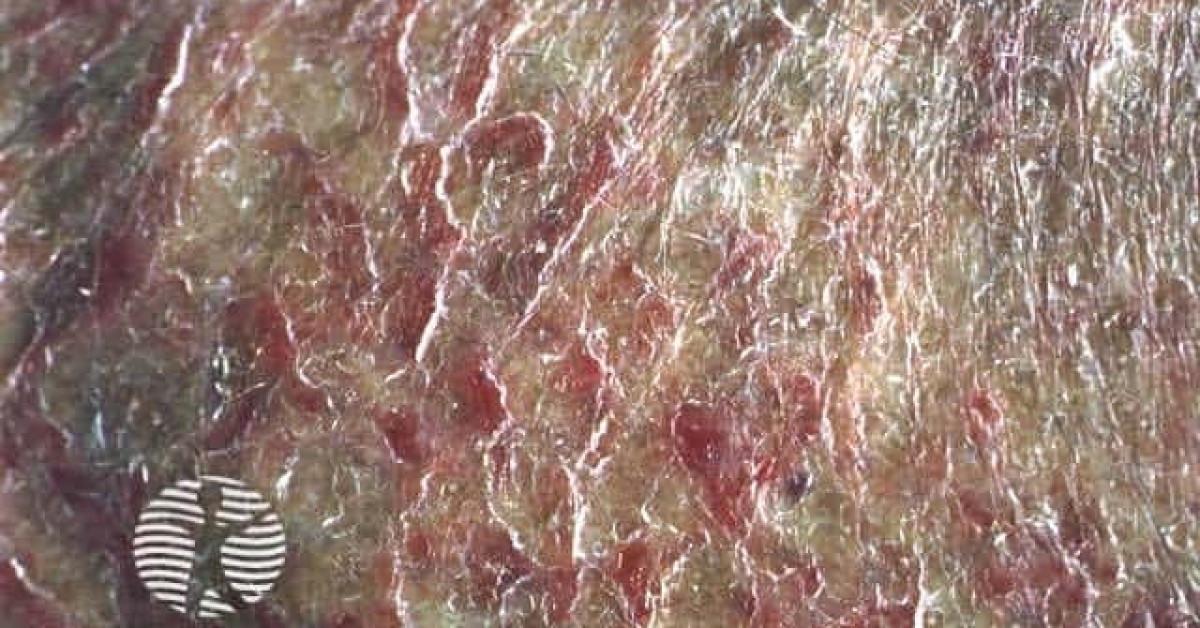 Asteatotic eczema image