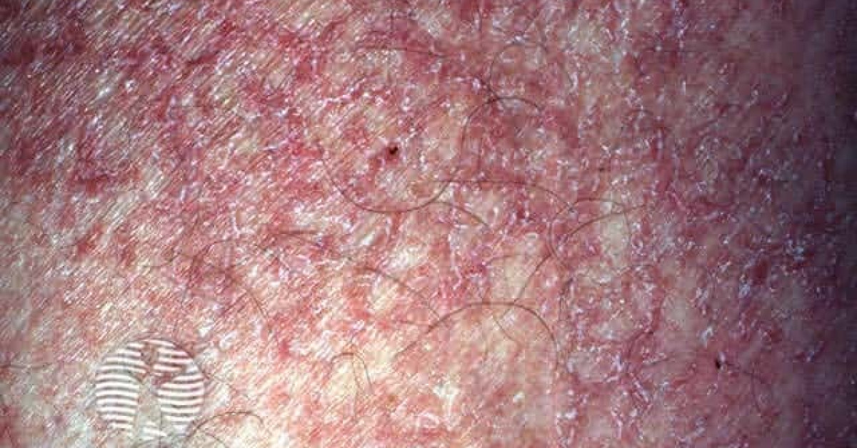 Asteatotic eczema image