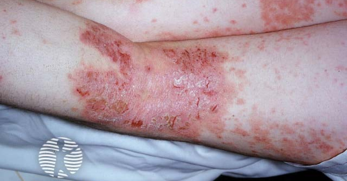 Atopic dermatitis image