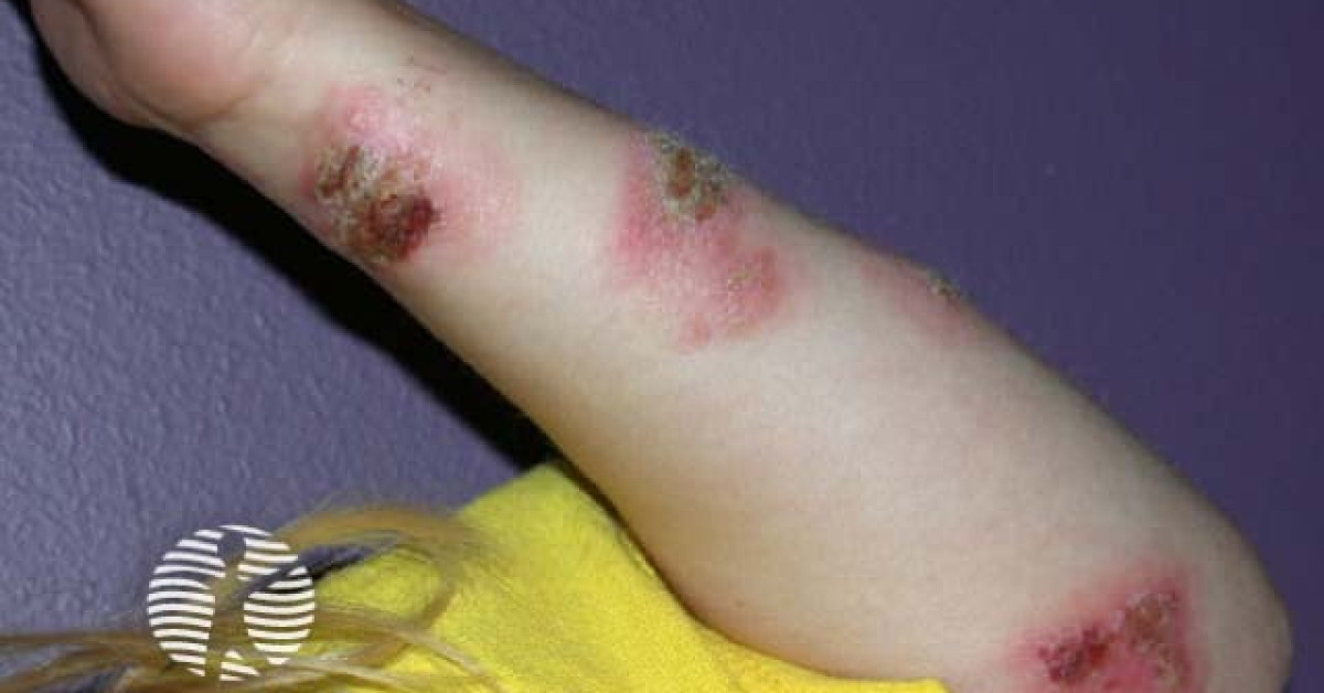 Exudative nummular dermatitis image