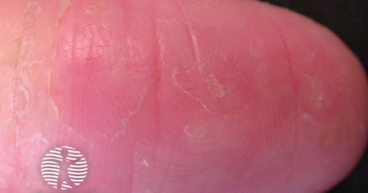 Hand dermatitis image