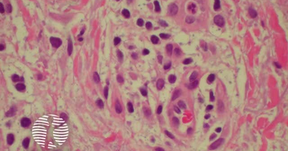 Dermal inflammatory infiltrate in eczema image