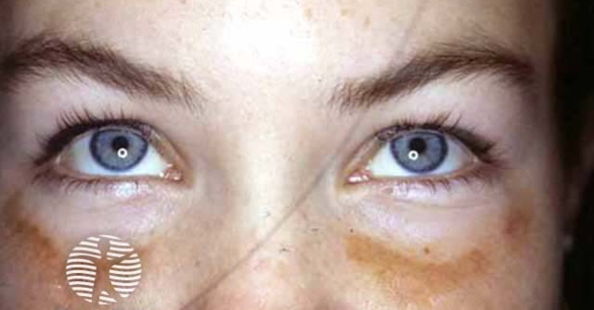 Benzoyl peroxide reaction image