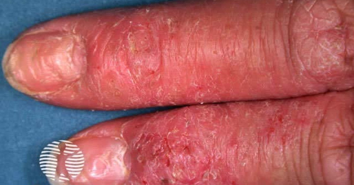 DermNet® - Hand dermatitis image