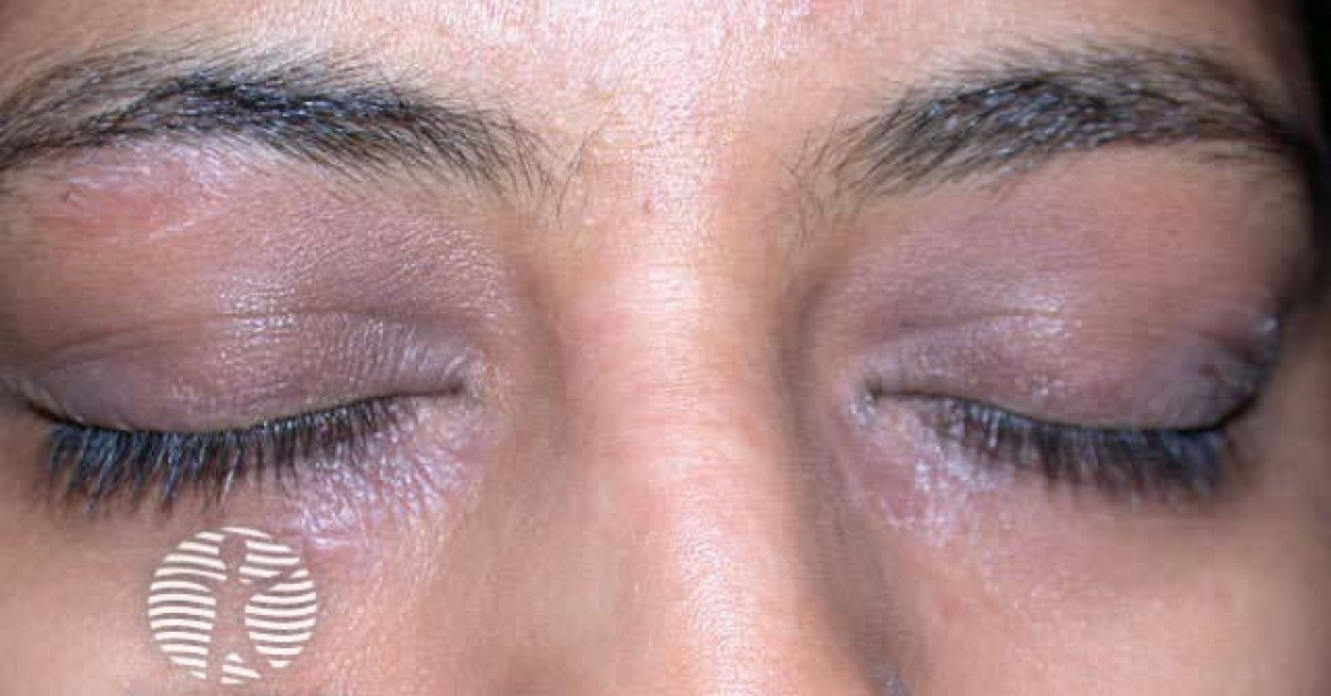 Eyelid dermatitis image