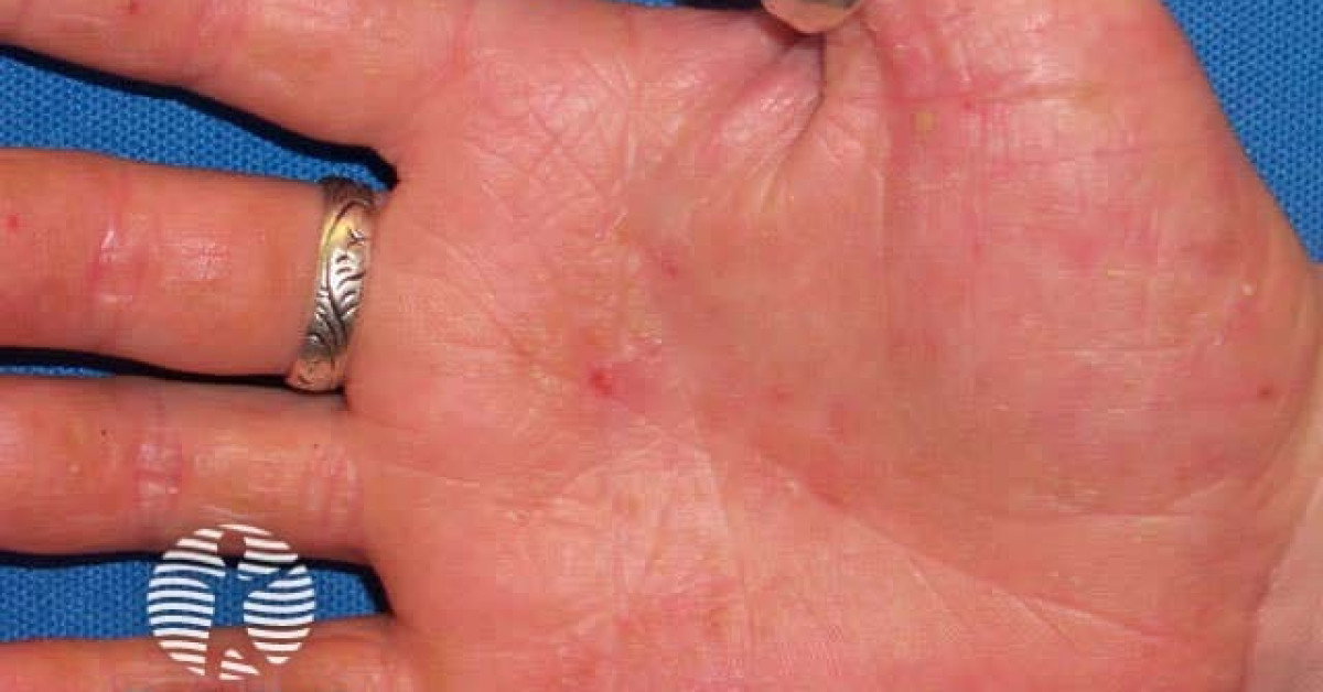 Hand dermatitis image