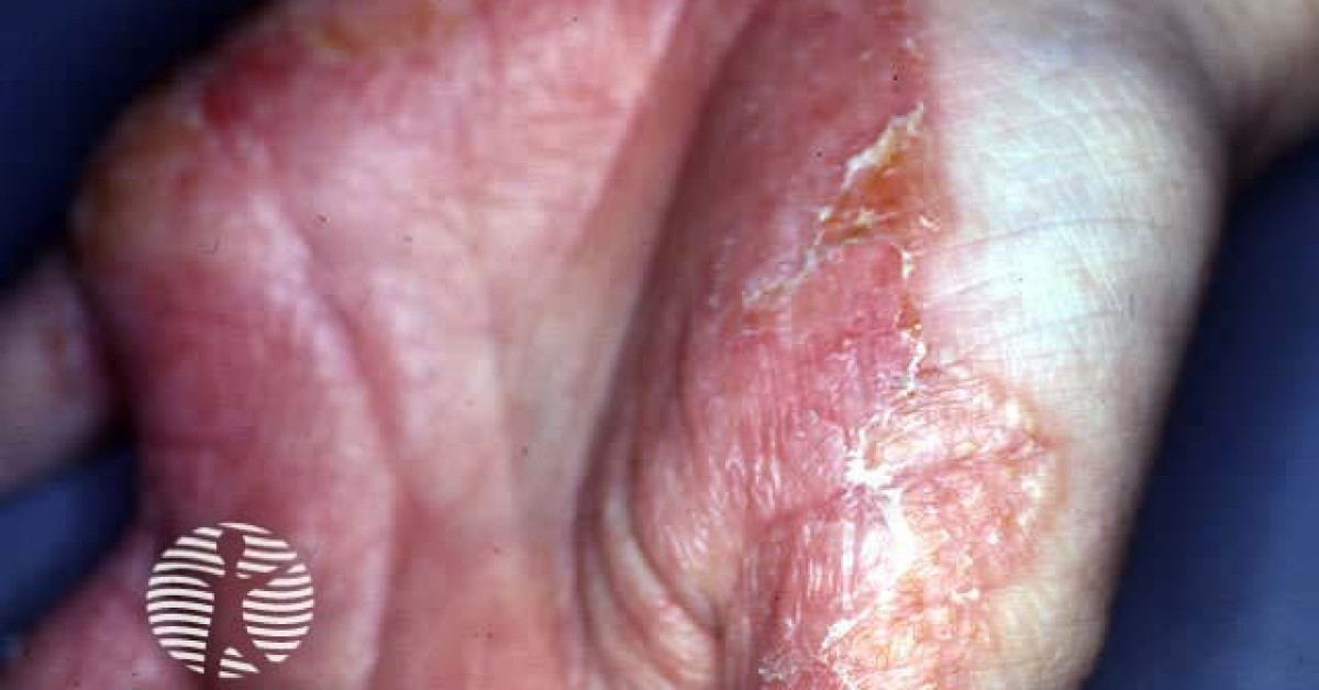 DermNet® - Tinea manuum image