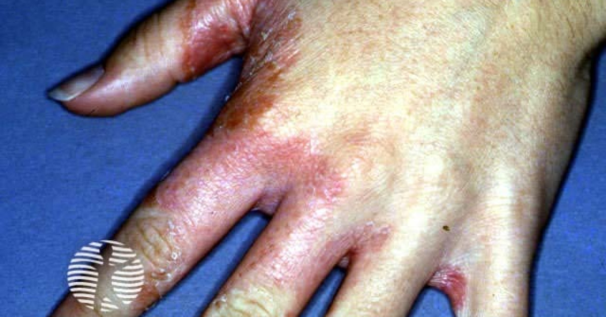 Tinea manuum image