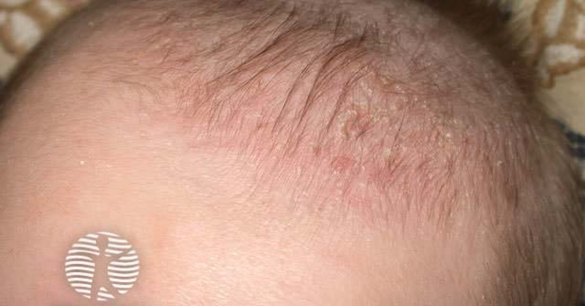 Infantile seborrhoeic dermatitis image