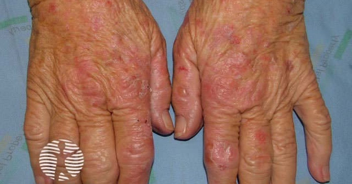 DermNet® - Reaction to doxycycline image