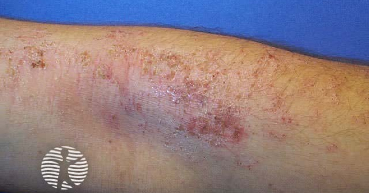 Subacute dermatitis image
