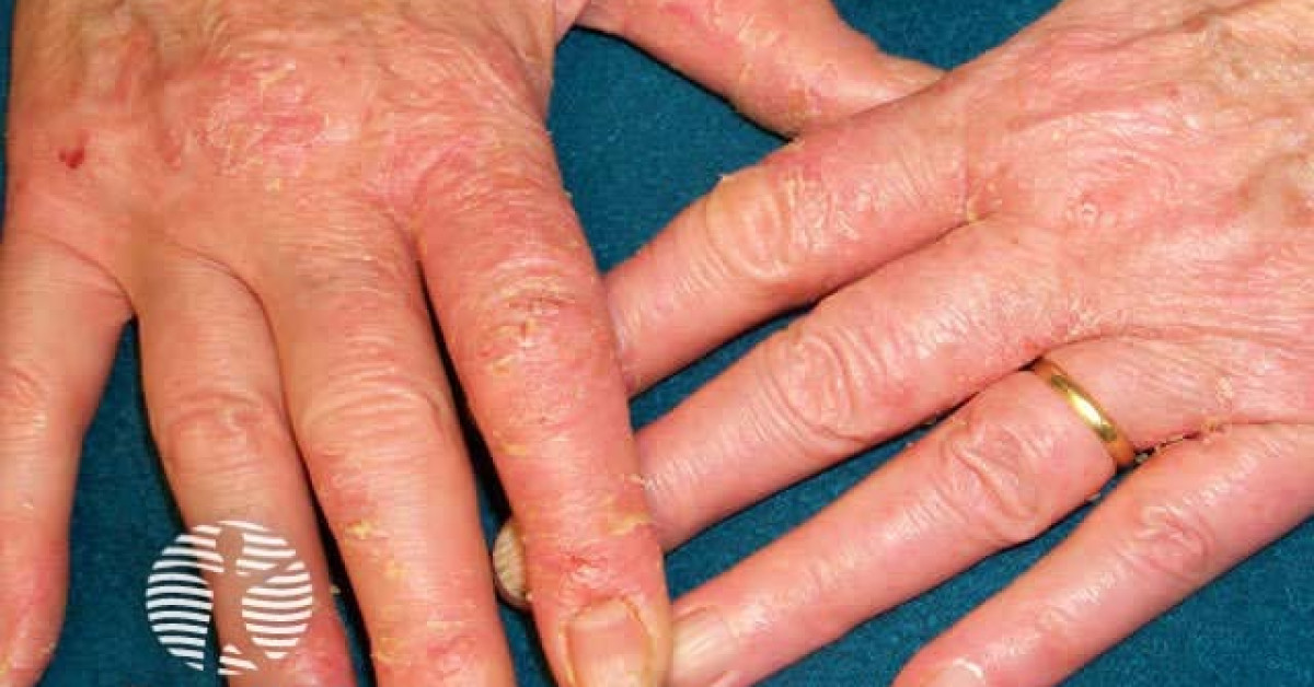 Subacute dermatitis image