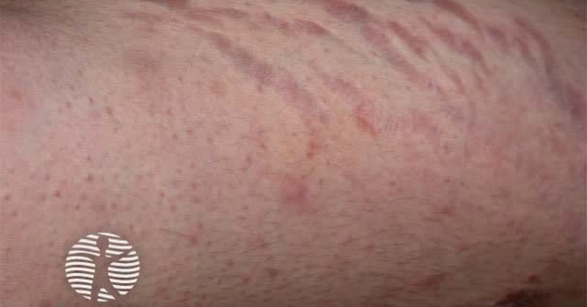 Steroid atrophy: striae image