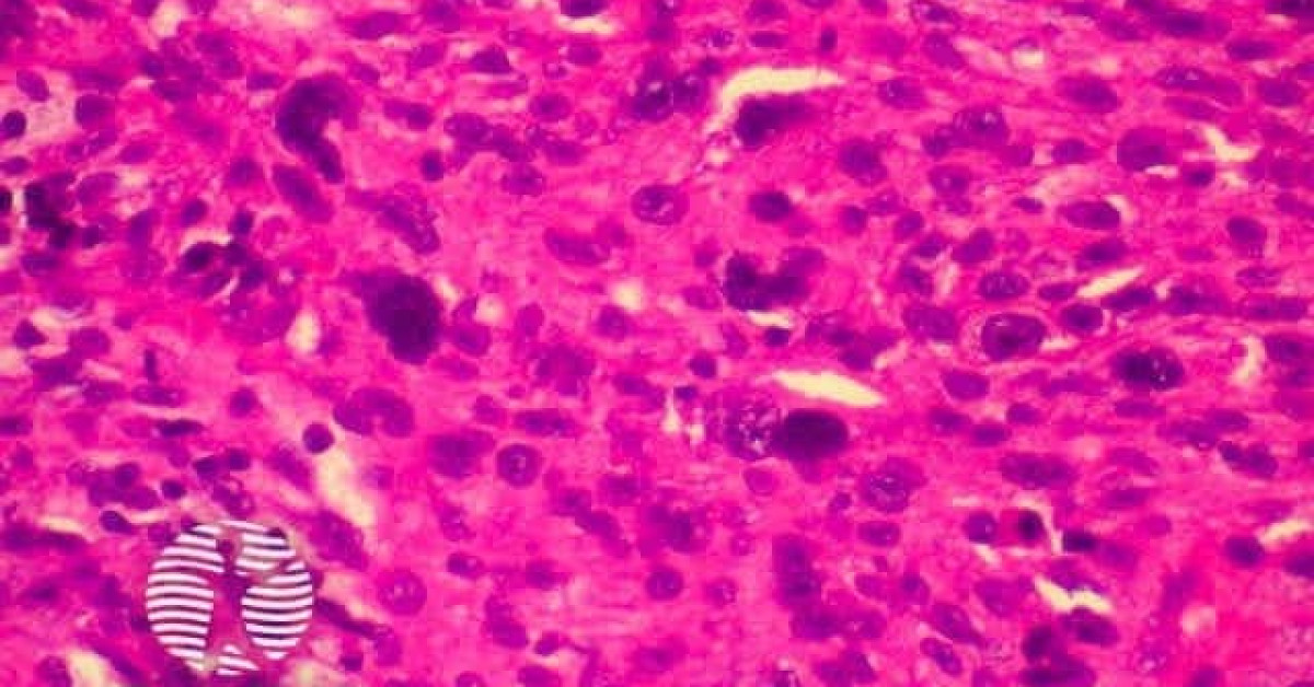 pathology of atypical fibroxanthoma image