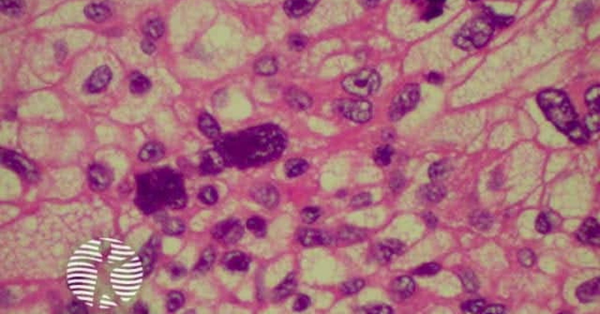 pathology of atypical fibroxanthoma image