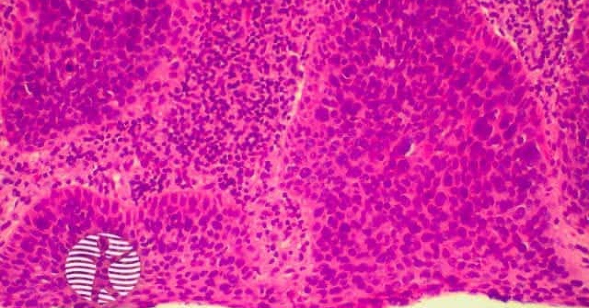 Pathology of in situ SCC image