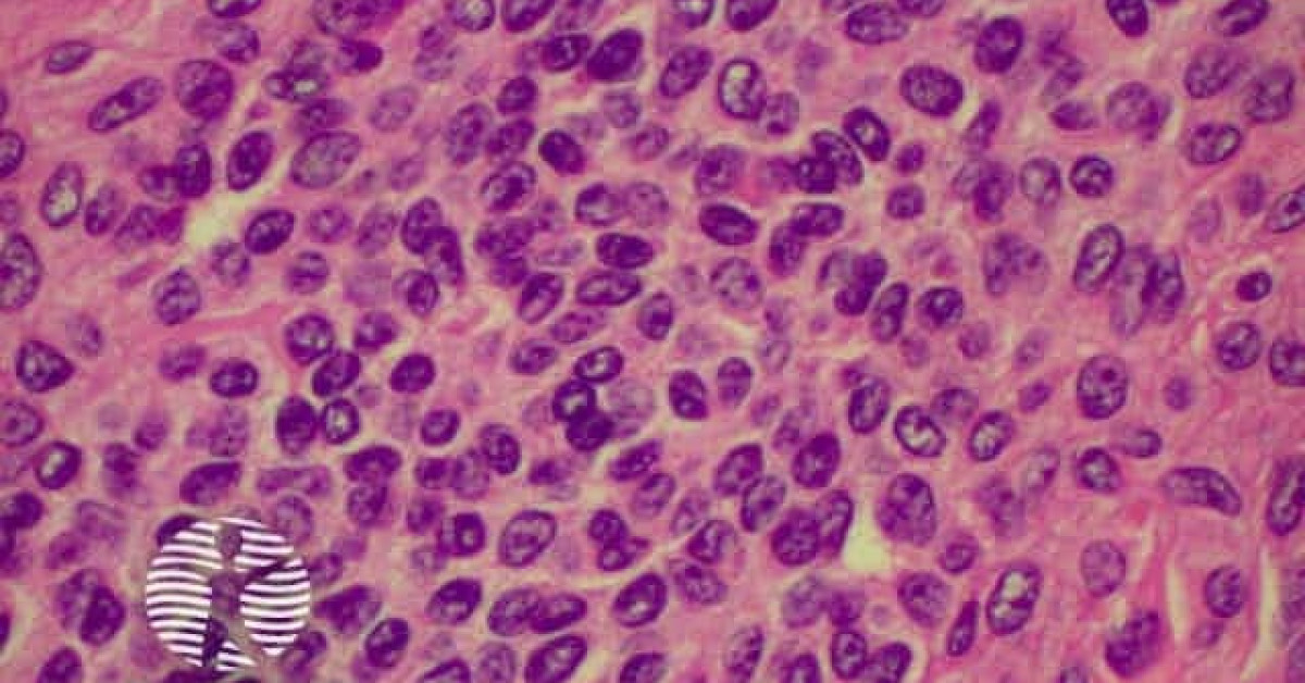 Pathology of deep naevus cells image