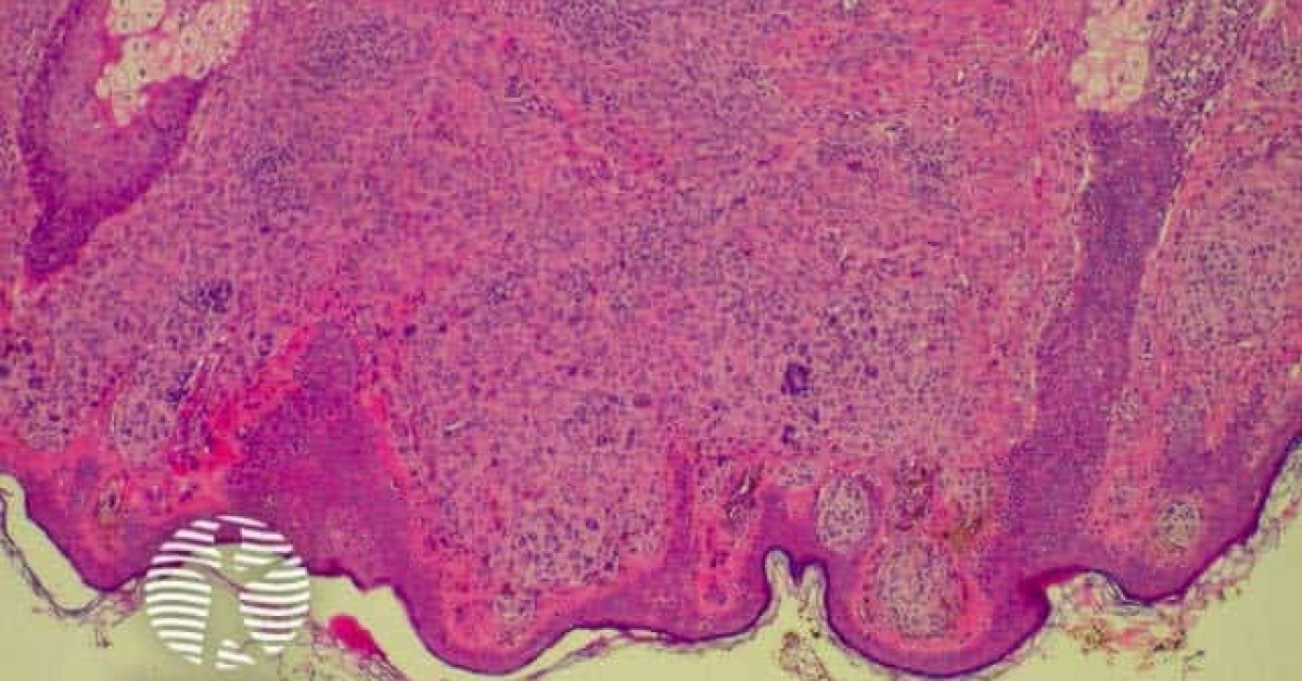 Pathology of dermal naevus image