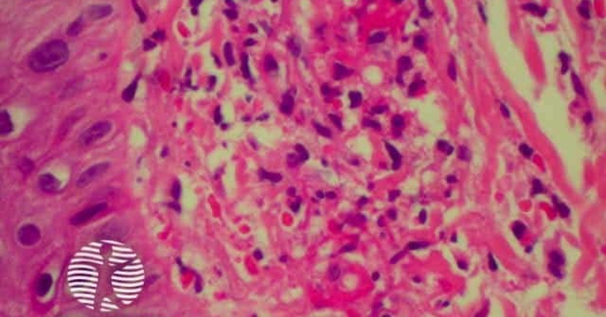 Leucocytoclastic vasculitis image