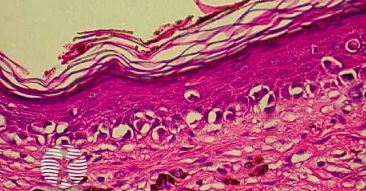 Pathology of Spindle cell tumour image