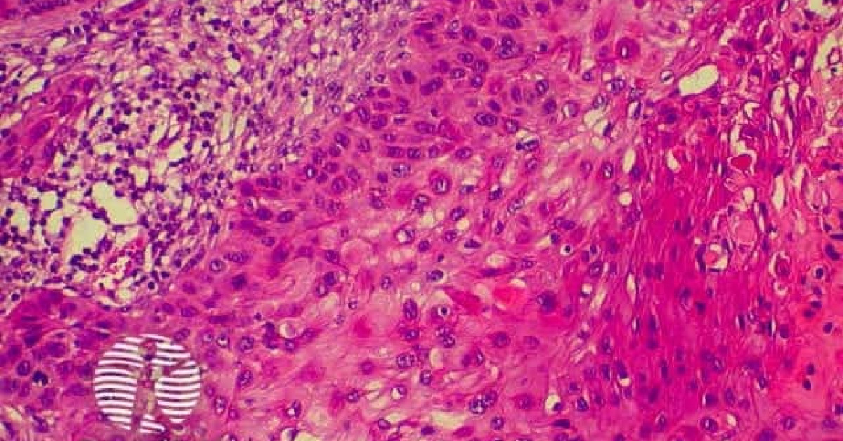 Pathology of SCC image