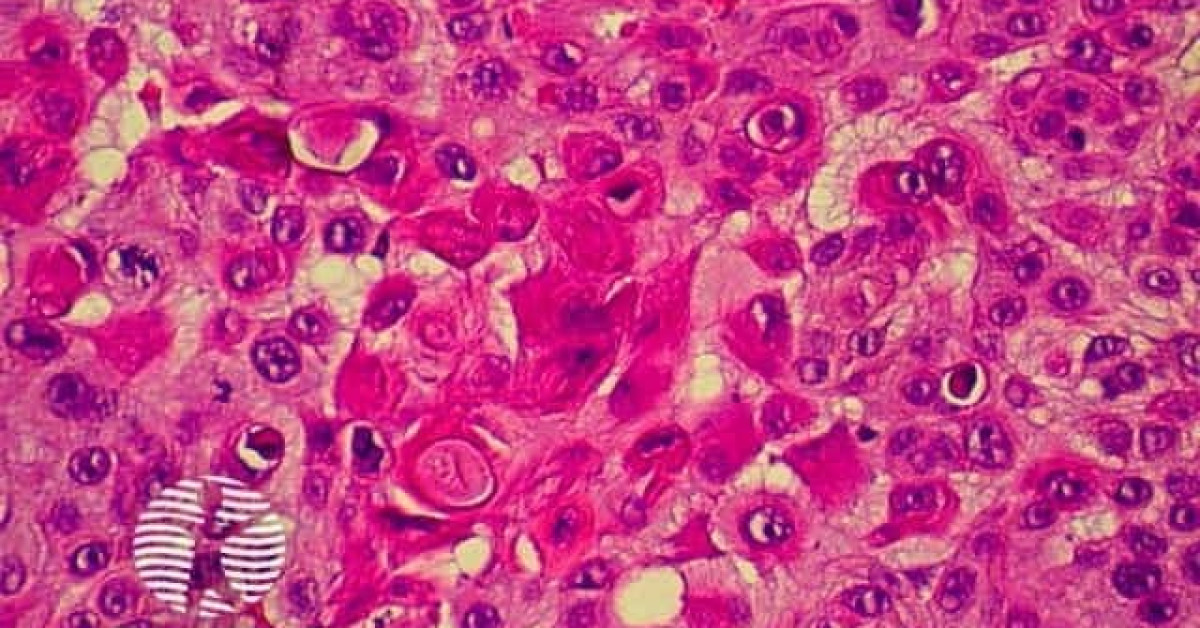 Pathology of SCC image